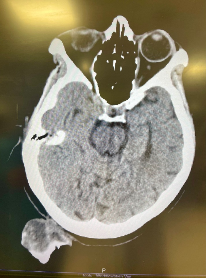Gigantic cutaneous horn: A case report and review of literature ...