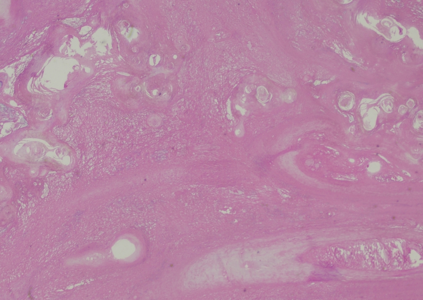 Gigantic cutaneous horn: A case report and review of literature ...