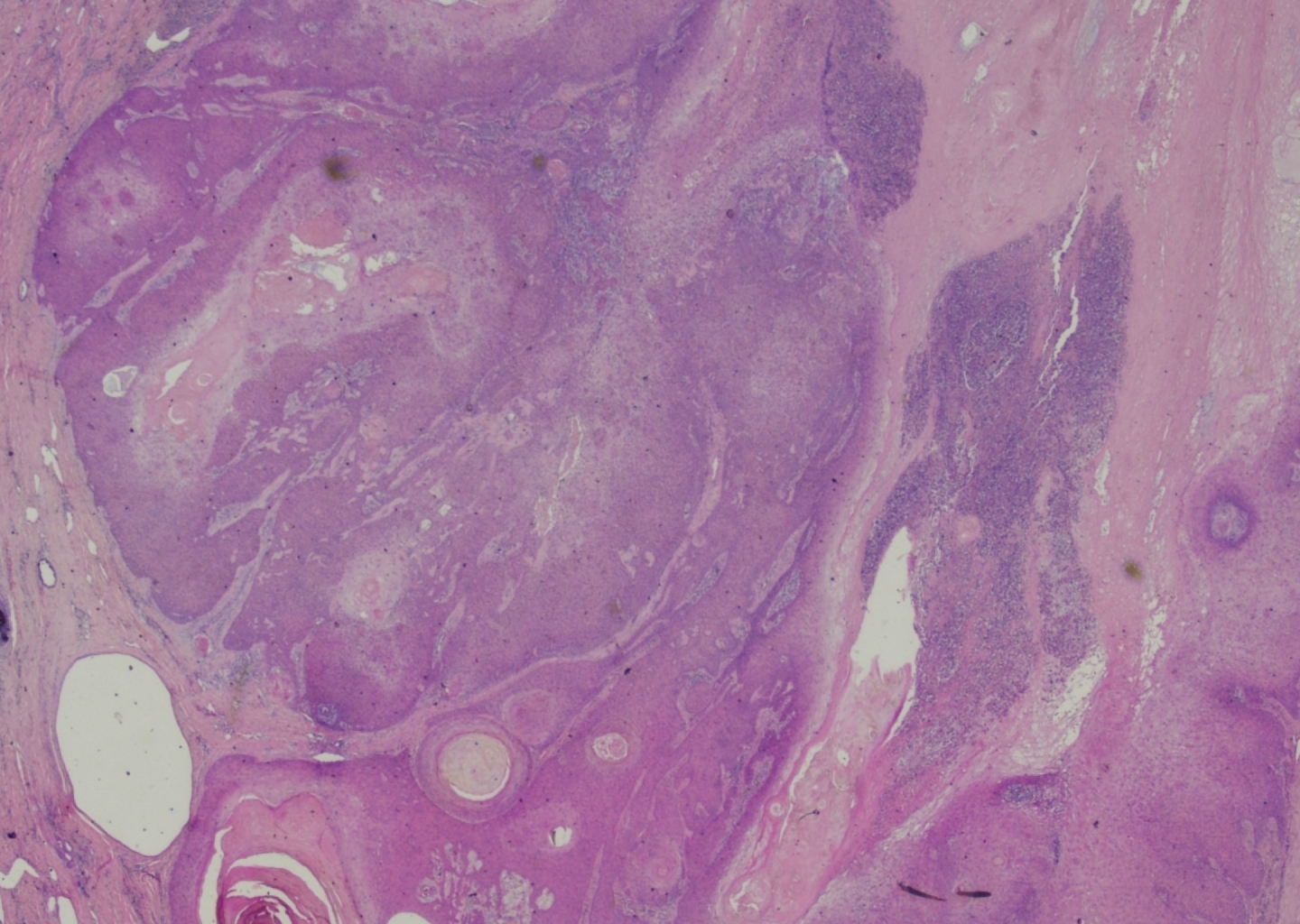 Gigantic cutaneous horn: A case report and review of literature ...