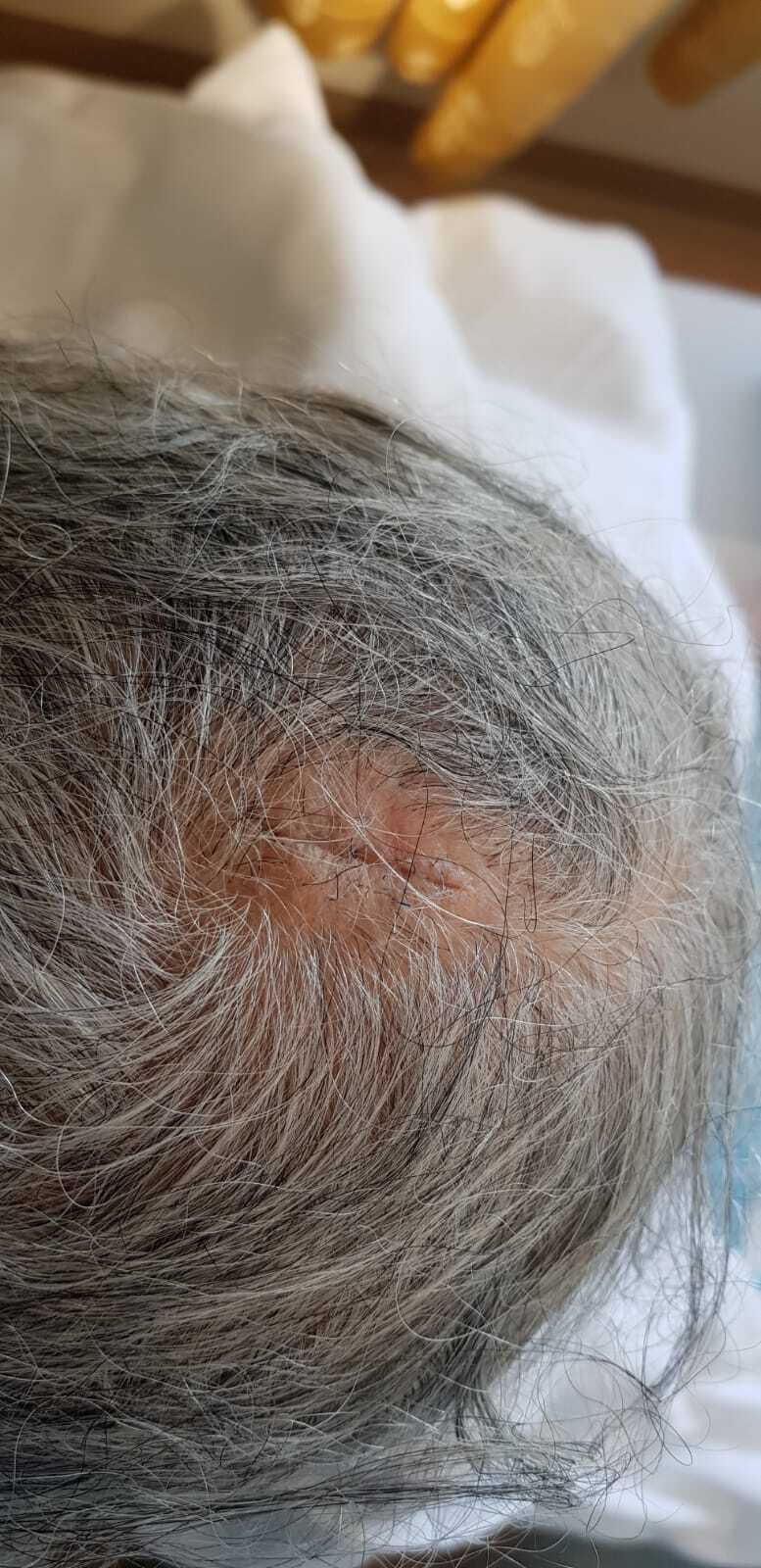 Gigantic cutaneous horn: A case report and review of literature ...