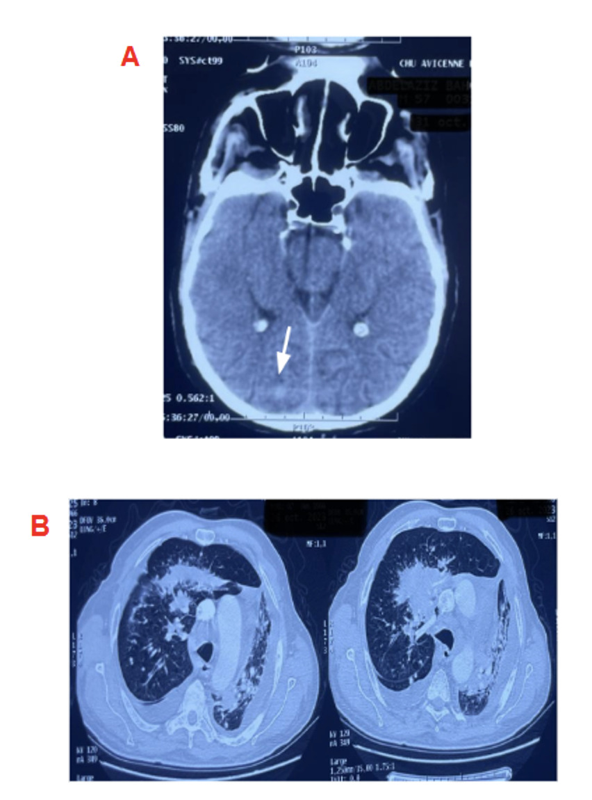 Metastatic cancer and anti-GBM disease, a rare but possible entity : A ...